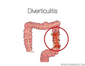 6 Best Probiotics For Diverticulitis – Study Results - Probiotic Review ...
